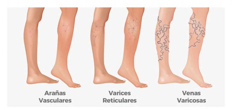 Las varices desde edades tempranas requieren tratamiento - Revista ...